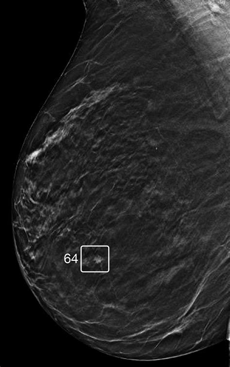 Artificial Intelligence Ai For Screening Mammography From The Ajr