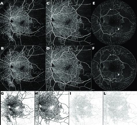 Swept Source Optical Coherence Tomography Angiography Ss Octa And Download Scientific Diagram
