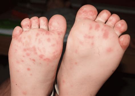 7 Possible Causes Of Red Dots On Feet Hubpages