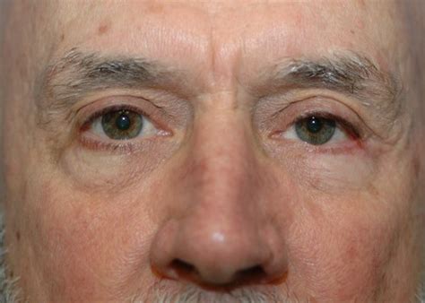 Skin Cancer Reconstruction 17 Amadi Aesthetics Plastic Surgery And Med Spa