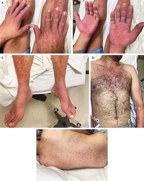 Case 28 2023 A 37 Year Old Man With A Rash Nejm