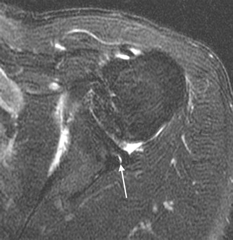 Glenoid Dysplasia Incidence And Association With Posterior Labral