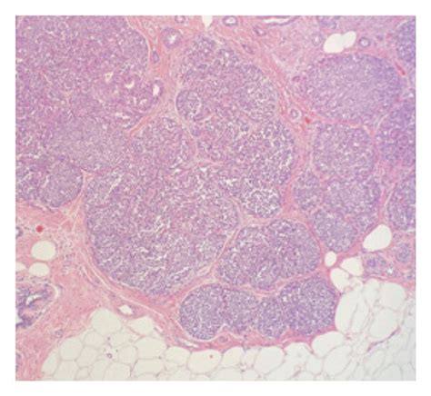 Classification Of Lobular Carcinoma In Situ A Classic Lcis Hande Download Scientific Diagram