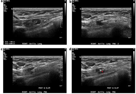 Grayscale Sonographic Images Of A Metastatic Axillary Lymph Node With Download Scientific