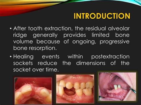 Ppt Socket Preservation Procedure After Tooth Extraction Powerpoint Presentation Id 1873400