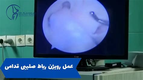 عمل رویژن رباط صلیبی قدامی توسط دکتر پویان علوی نژاد نماشا
