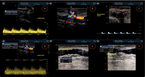 Figure 2 From Recognizing Dialysis Access Steal Syndrome With Central