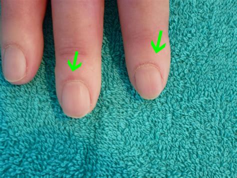 Scleroderma Hands 2 Doccheck