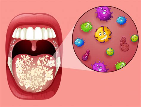 Oral Thrush Symptoms And What To Do If You Suffer From It London