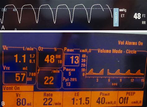 A Abnormal Wave Form Of Capnography Monitoring B Ventilator