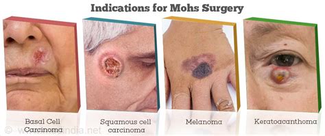 mohs surgery for skin cancer advantages risks and complications
