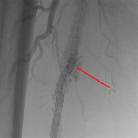Superficial Femoral Artery Sfa Angiogram Diffuse And Long Segment Download Scientific