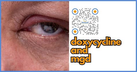 Doxycycline And Meibomian Gland Dysfunction Understanding Treatment For Dry Eyes