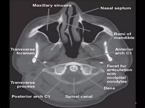 Delineation Of Nodal Volumes And Oars A Problem Based Approach Pptx
