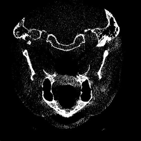 Lower Jaw Dental Implants Dental Orthodontic Maxillofacial Cts