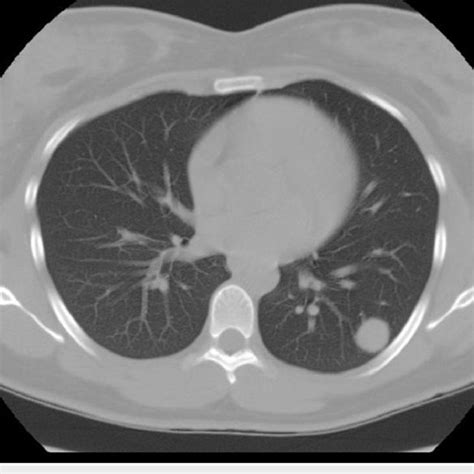 Computed Tomography Of Chest Showing Pulmonary Nodule Even With The Download Scientific