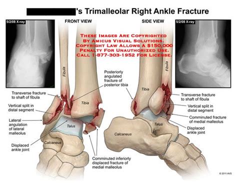 Trimalleolar Ankle Fracture Ankle Fracture Broken Ankle Recovery Ankle Surgery