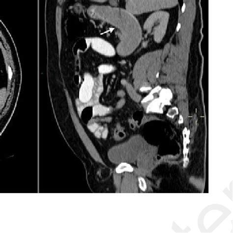 Abdominal Ct Scan Axial Left Sagittal Right Showing Tumour Download Scientific Diagram