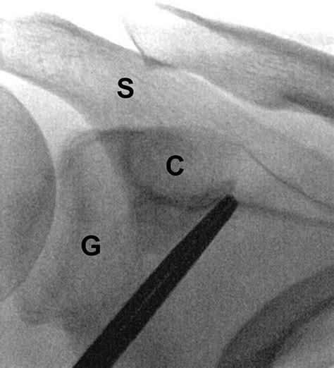 Suprascapular Nerve Block Fluoroscopy