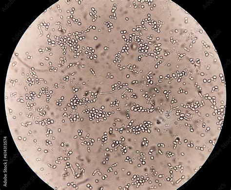 Budding Yeast Cells In Patient Urine Urinary Tract Infections