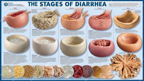 Guía Visual De Las Etapas De La Anatomía De La Diarrea Y La