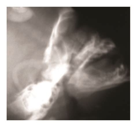 Radiographs Of The Cortical Hyperostosis A And B Massive