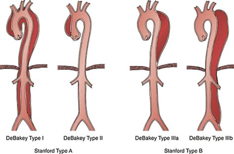 Aortic Pathology Aaa Dissection And Traumatic Transection Thoracic Key