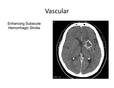 Ring Enhancing Lesion In Hiv Positive Patient Ppt