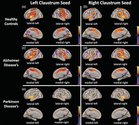 Seed‐to‐voxel Functional Connectivity With Bilateral Claustrum Showing