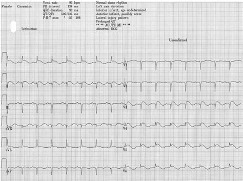 Electrocardiogram ECG On Presentation Demonstrating A Prolonged QT Download Scientific