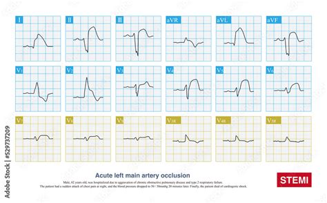 Acute Left Main Artery Occlusion Can Cause Both St Segment Elevation And Non St Segment