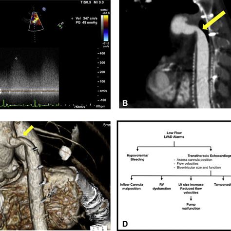 Lvad Outflow Cannula Obstruction Download Scientific Diagram