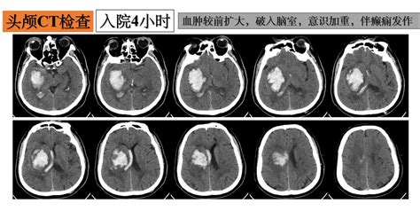 手术病例分享24：急诊内镜下行右侧基底节区脑出血（附手术视频） 脑医汇