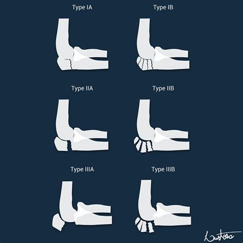 Olecranon Fracture Clinical Tool Emergency Care Institute