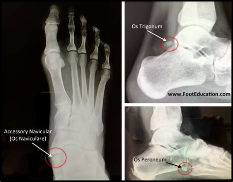 Accessory Ossicle Great Toe At Darcy Ryan Blog