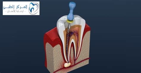 Learn About Alternatives To Root Canal Fillings And When Patients Need Them المركز الطبي