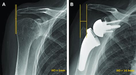 Preoperative Humeral Offset A And Postoperative Offset B Were