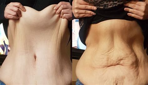 Here Is A Complete Guide On The Causes Of Saggy Skin Beauty For World