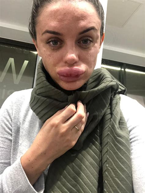 Botox Gone Wrong Womans Lips Left Swollen After Getting Fillers From Ex Cons Small Joys