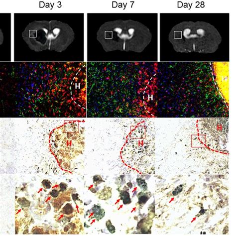Glial Response And Iron Deposition In The Perihaematomal Region