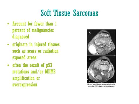 Ppt Mdm2 And Soft Tissue Sarcomas Powerpoint Presentation Free Download Id 3595179