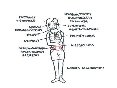 Hyperthyroidism Clinical Features And Its Management Ppt