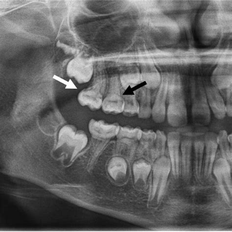 Pictorial Representation Of Permanent Outer Arch And Primary Inner