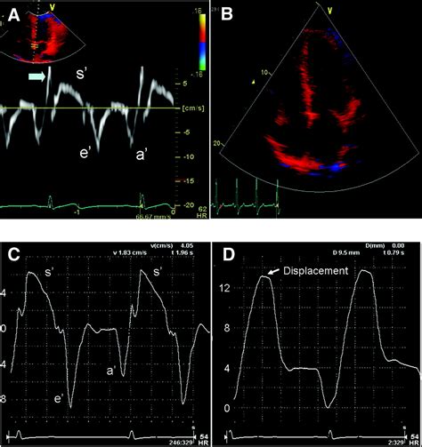 Role Of Tissue Doppler And Strain Echocardiography In Current Clinical