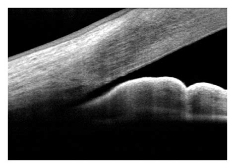 Angle Assessment By As Oct Narrow Occludable Angle A Plateau Iris