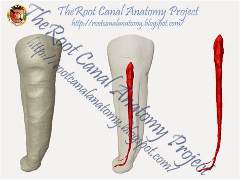 The Root Canal Anatomy Project Mandibular First Premolar Two Root Canals
