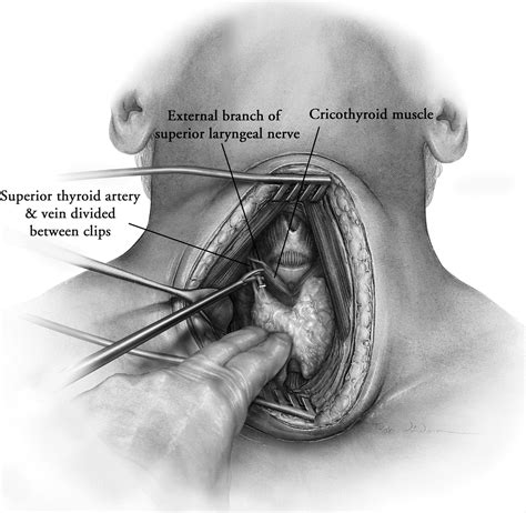 Conventional Thyroidectomy Operative Techniques In Otolaryngology Head And Neck Surgery