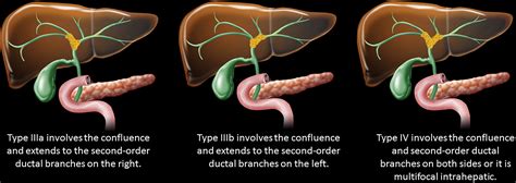 Extrahepatic Cholangiocarcinoma What The Surgeon Needs To Know