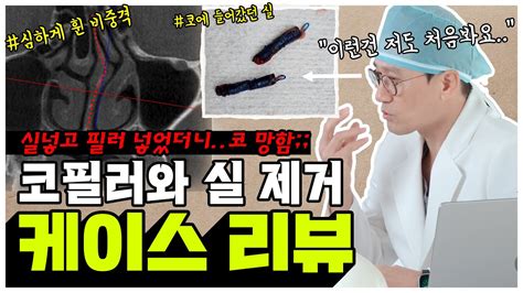 코필러 녹이기 코실리프팅 제거 및 휘어진 비중격교정 한 코성형 전후 케이스 리뷰 30대 초반 여자 코수술 리뷰 코성형 Ct영상 有 비염수술 비중격교정술 Youtube