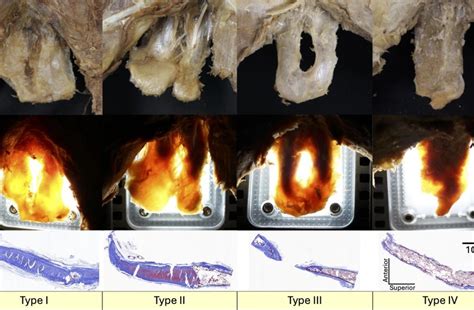 Xiphoid Process Anatomy Sc Mahidol Anatomy Musc ภาควิชา